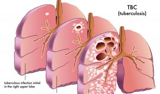 Sanatorium voor tbc-patiënten in Brussel | gezondheid.be