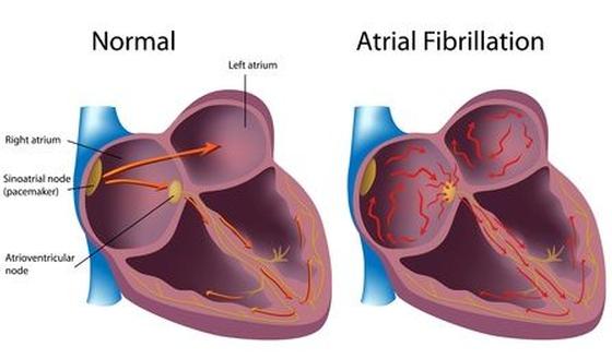 Voorkamer- of atriumfibrillatie: de meest voorkomende hartritmestoornis ...