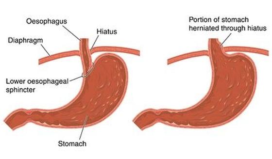 Een maagbreuk of hernia van het middenrif | gezondheid.be