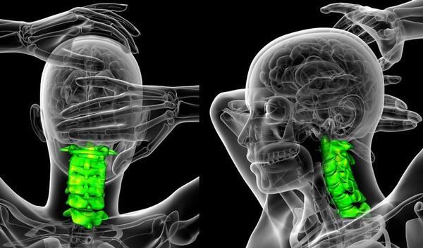 Nekhernia of Hernia Nuclei Pulposi (HNP) | gezondheid.be