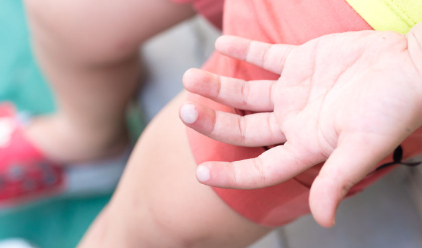 Zwaardere brandwonden bij kinderen door aanlaten kleding en luier ...