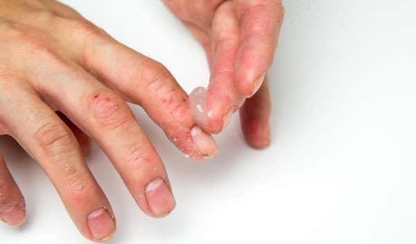 Handen wassen: advies voor mensen met psoriasis of eczeem | gezondheid.be