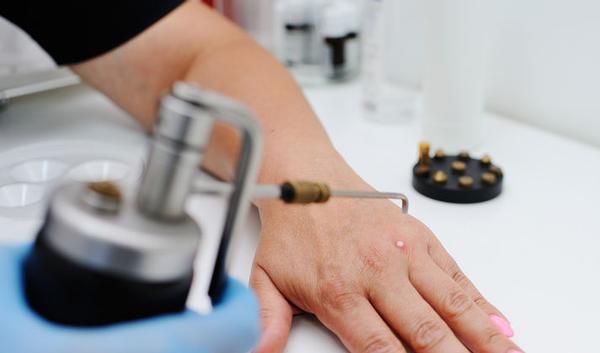 Hoe worden wratten behandeld? | gezondheid.be