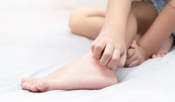 Hoe kan je een muggenbeet best verzorgen? | gezondheid.be