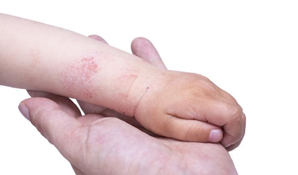 Een behandeling voor eczeem kan ook astma verzachten | gezondheid.be