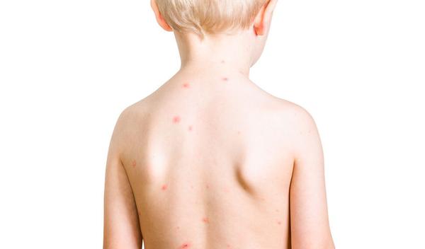 Rode vlekken en huiduitslag: hoe herken je kinderziektes? | gezondheid.be