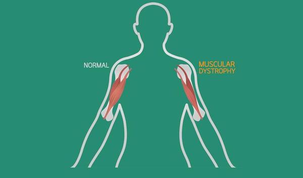 Ziekte van Duchenne of spierdystrofie (DMD) | gezondheid.be