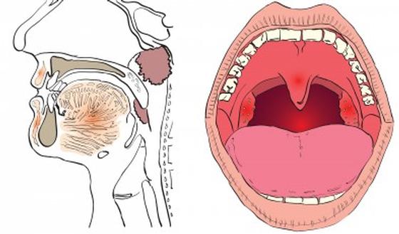 Geen pijnstillers met codeïne na amandeloperatie | gezondheid.be