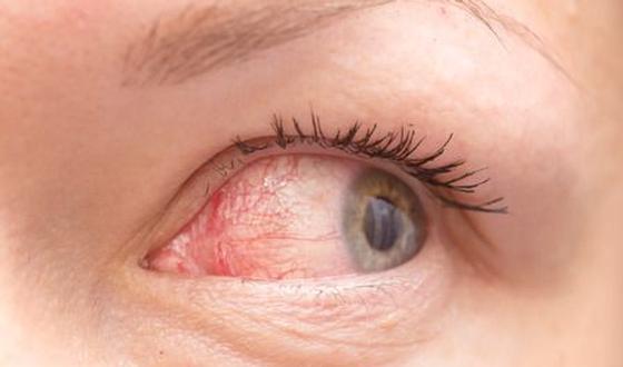 Rood oog: oorzaken en behandeling van een oogontsteking | gezondheid.be