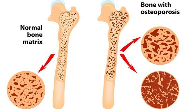 Welke geneesmiddelen nemen bij botontkalking of osteoporose ...