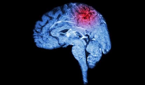 Beroerte: symptomen en behandeling | gezondheid.be