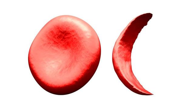 World Sickle Cell Day: Sikkelcelziekte: Zal uw kind de ziekte krijgen ...