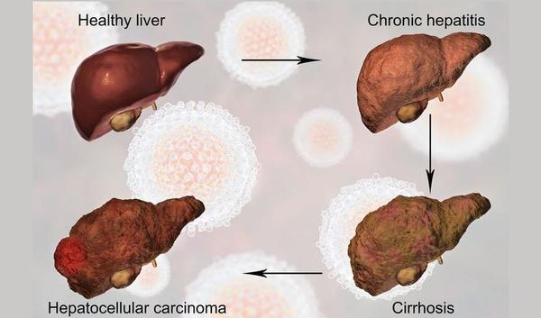 Leverfibrose vaststellen via een eenvoudige bloedtest. | gezondheid.be
