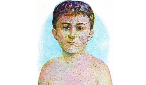 Waals gezondheidsagentschap waarschuwt voor mazelen | gezondheid.be