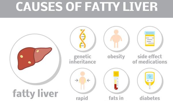 Niet-alcoholische leververvetting (NAFLD) en leverontsteking (NASH ...