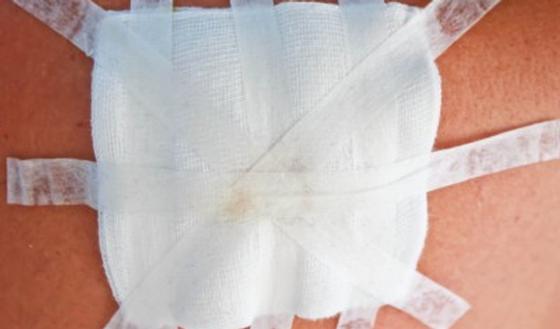 Open been (ulcus cruris) | gezondheid.be