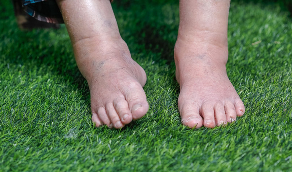Oedeem: wanneer zijn gezwollen benen, enkels en voeten gevaarlijk ...