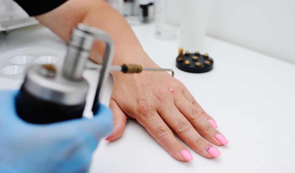 Hoe gaat cryotherapie in zijn werk? | gezondheid.be