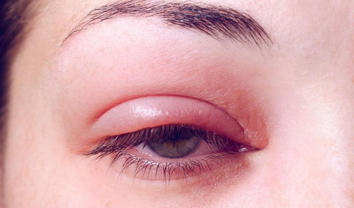 Gezwollen ooglid: ooglidontsteking of blefaritis | gezondheid.be