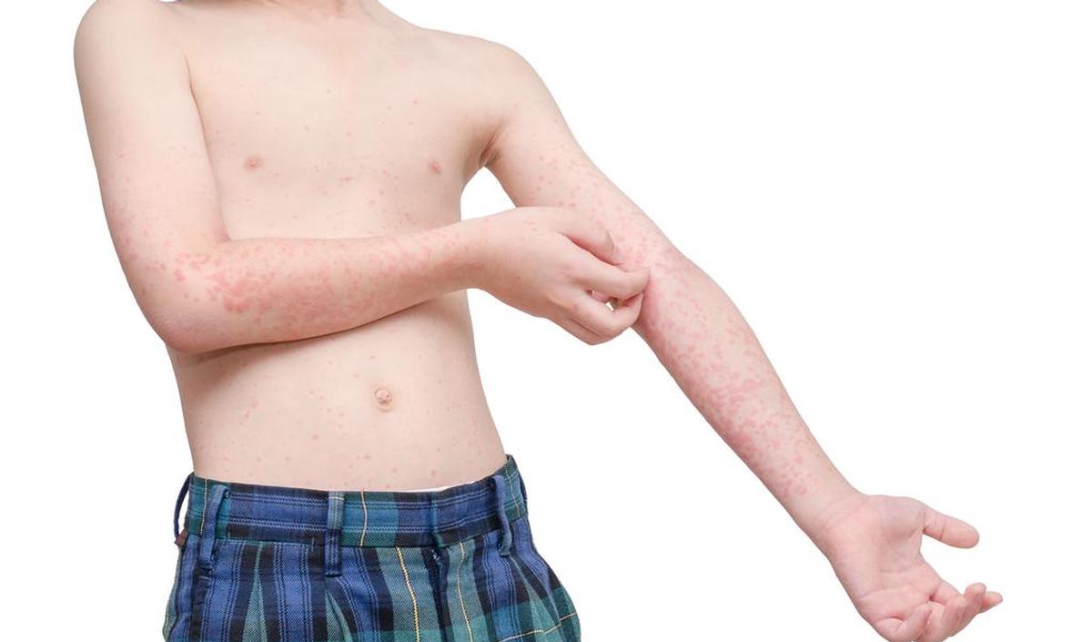 Rodehond of rubella: symptomen, verloop en behandeling | gezondheid.be