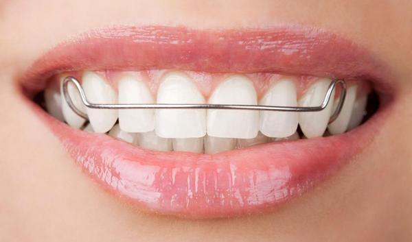 Alles wat je moet weten over een beugel | gezondheid.be