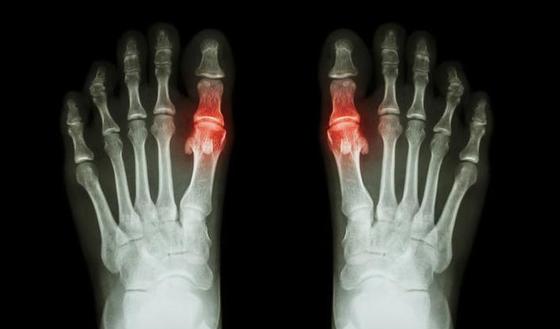 Jicht: oorzaken, symptomen en behandeling | gezondheid.be