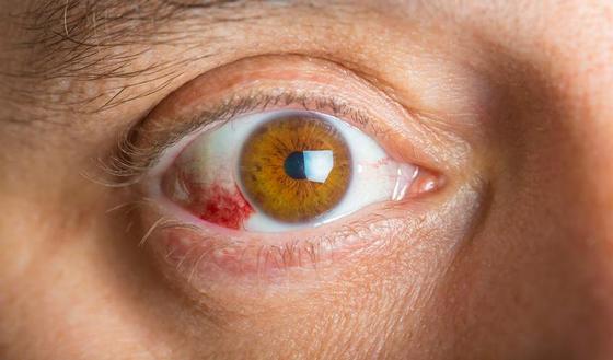 Wat doe je aan een bloeduitstorting in het wit van je oog? | gezondheid.be