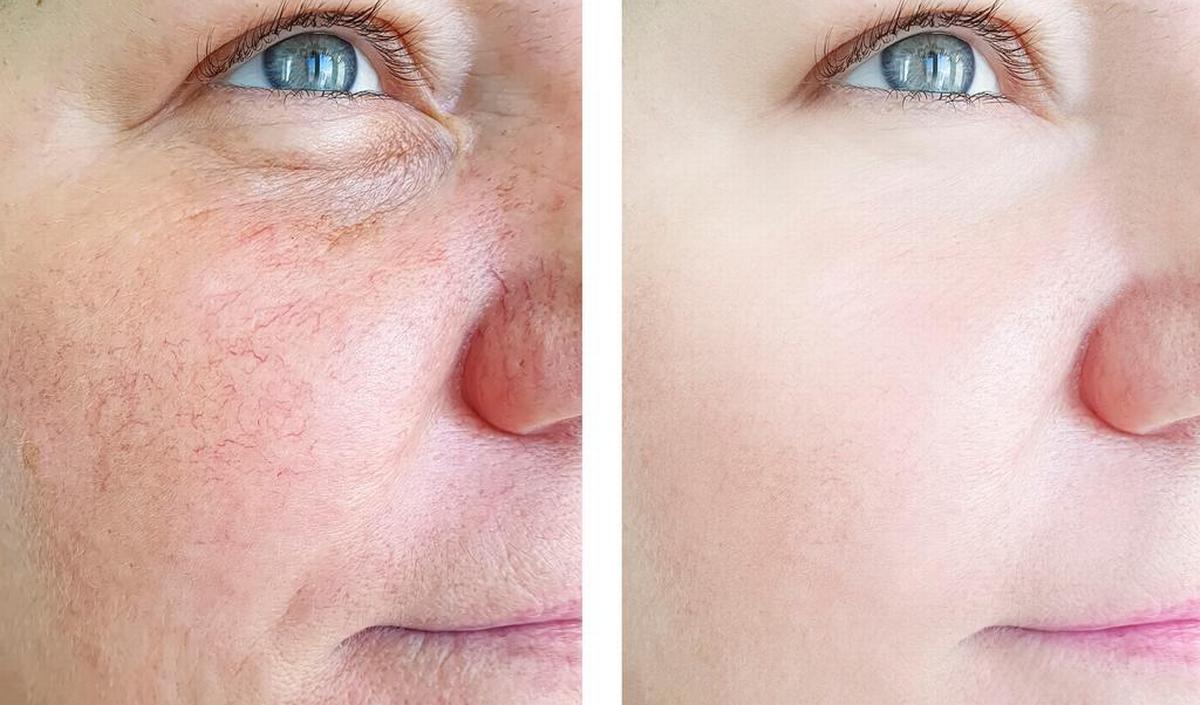 Couperose: oorzaak en behandeling | gezondheid.be