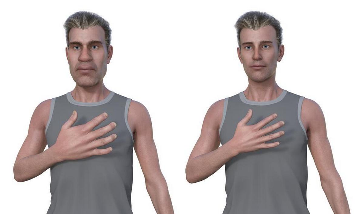 Acromegalie: getuigenis Lukas (19) | gezondheid.be