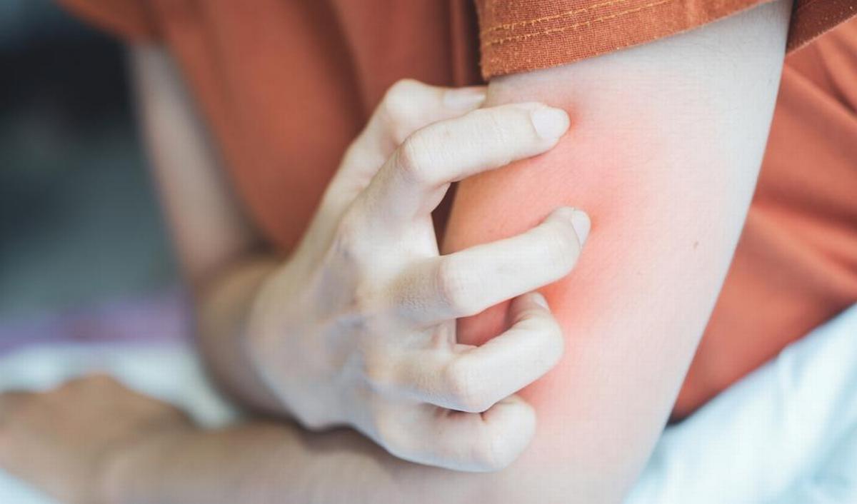 Wat doen bij een allergische reactie op insectenbeet? | gezondheid.be