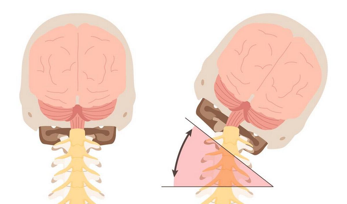 Dystonie: een bewegingsstoornis | gezondheid.be