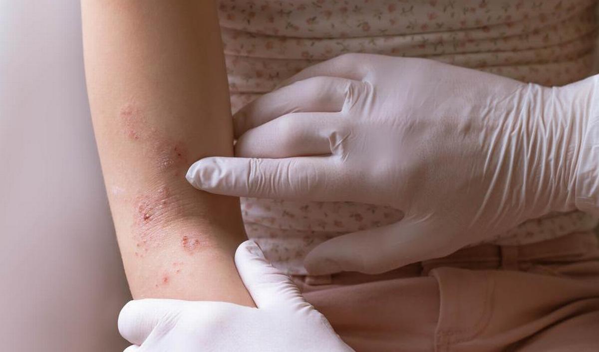 Natuurlijke behandeling voor eczeem: zijn vitamines, probiotica, zink ...