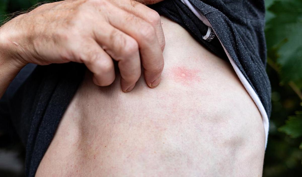 Spinnenbeet: hoe herkennen en wanneer naar de dokter? | gezondheid.be