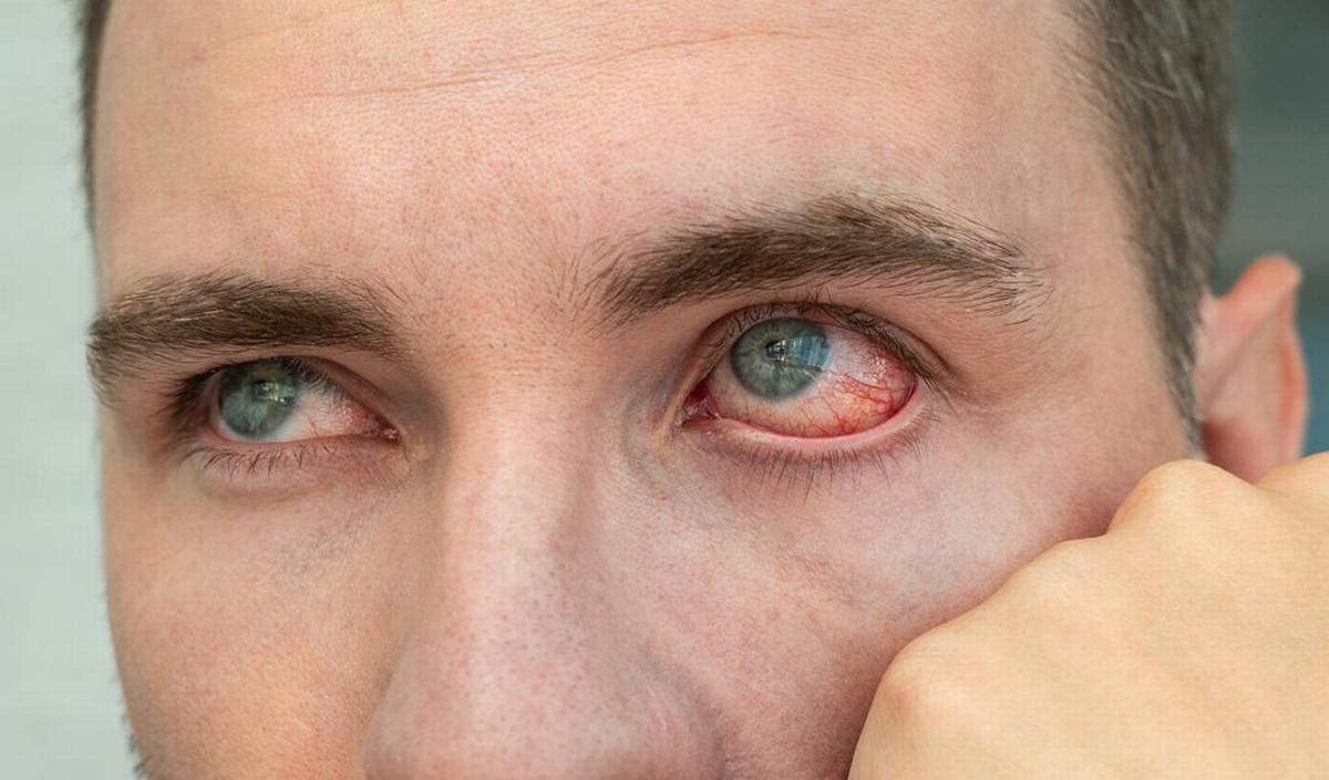 Lasogen: oogontsteking door UV-stralen | gezondheid.be