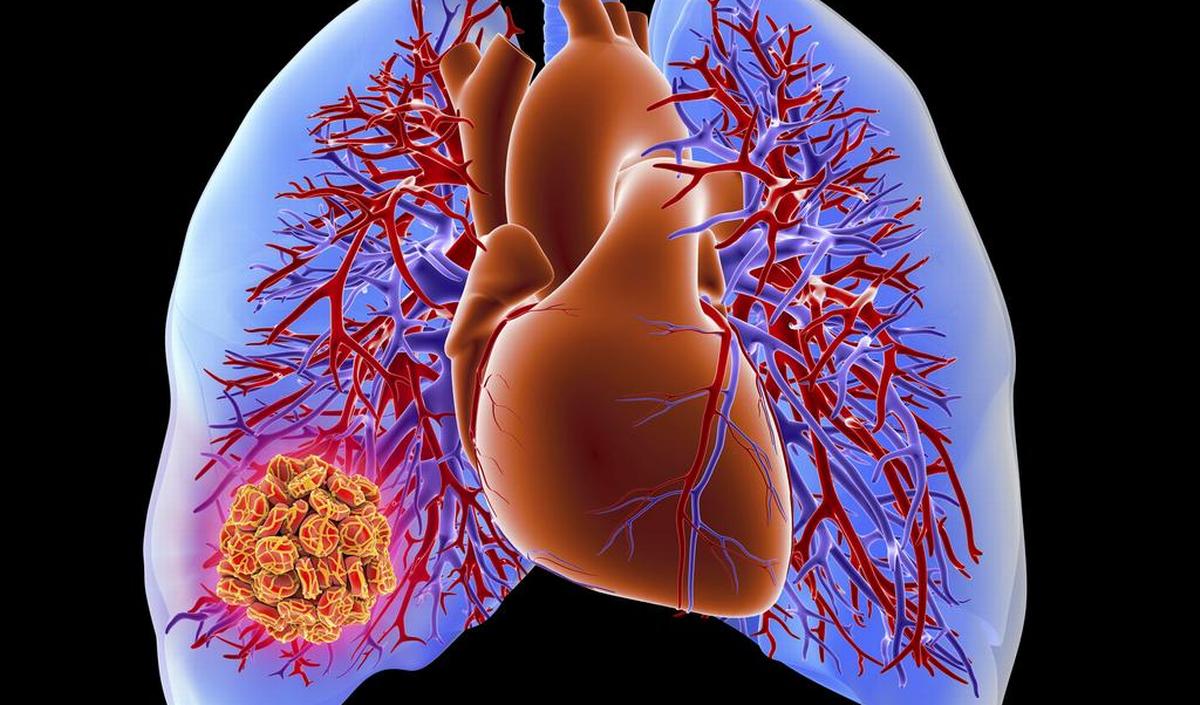 Longembolie: hoe gevaarlijk is een trombose in de longen? | gezondheid.be