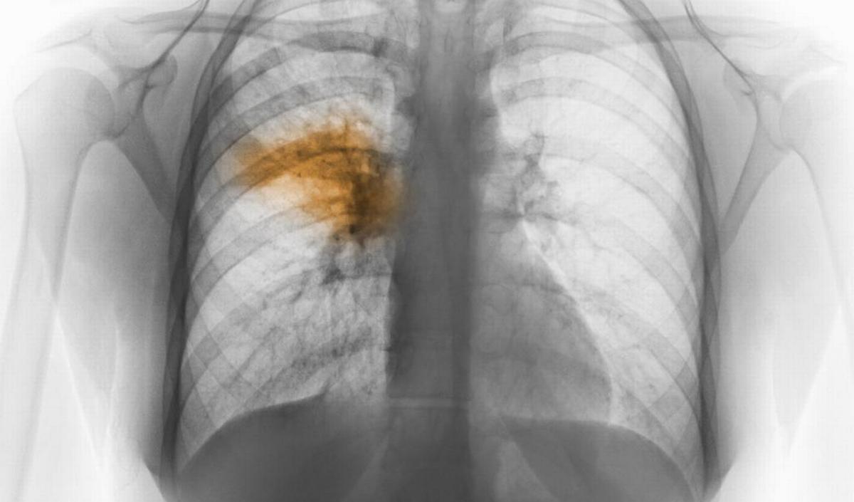 Longontsteking of pneumonie | gezondheid.be
