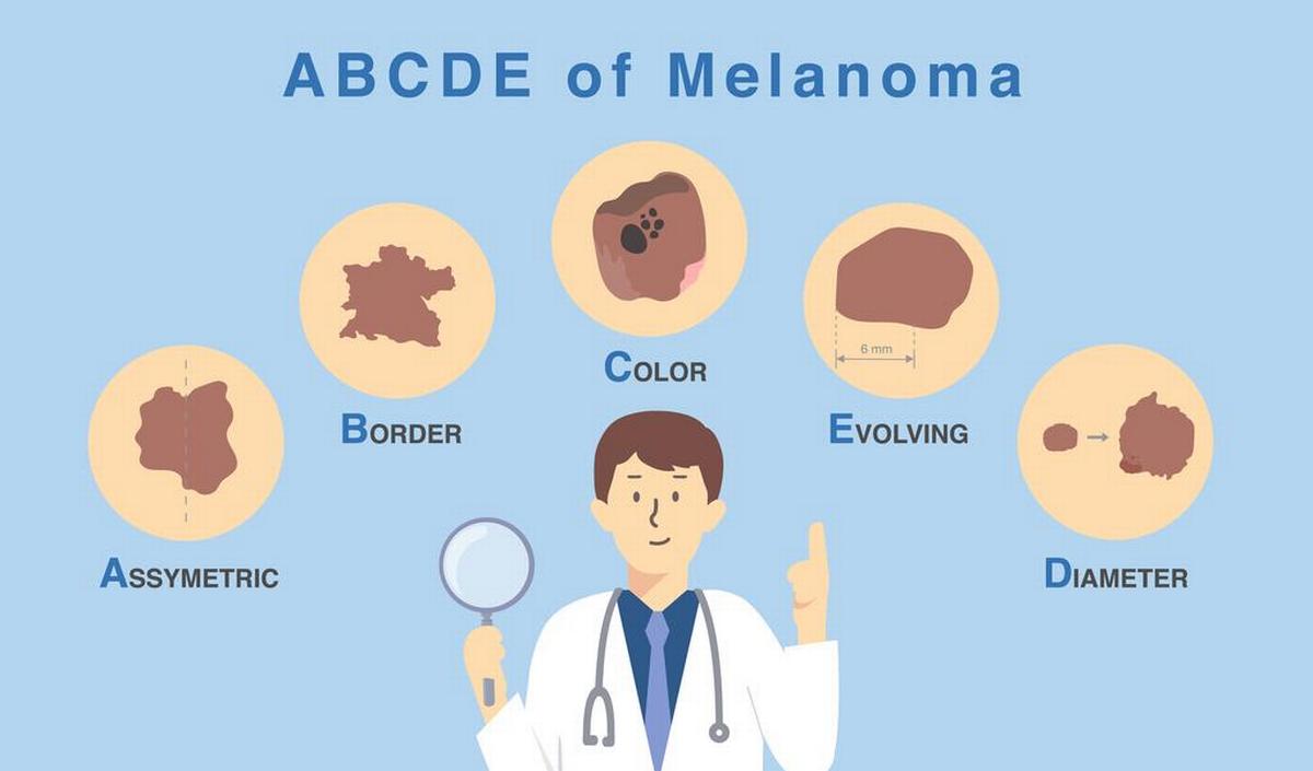 Melanoom herkennen: wat zijn de symptomen? | gezondheid.be