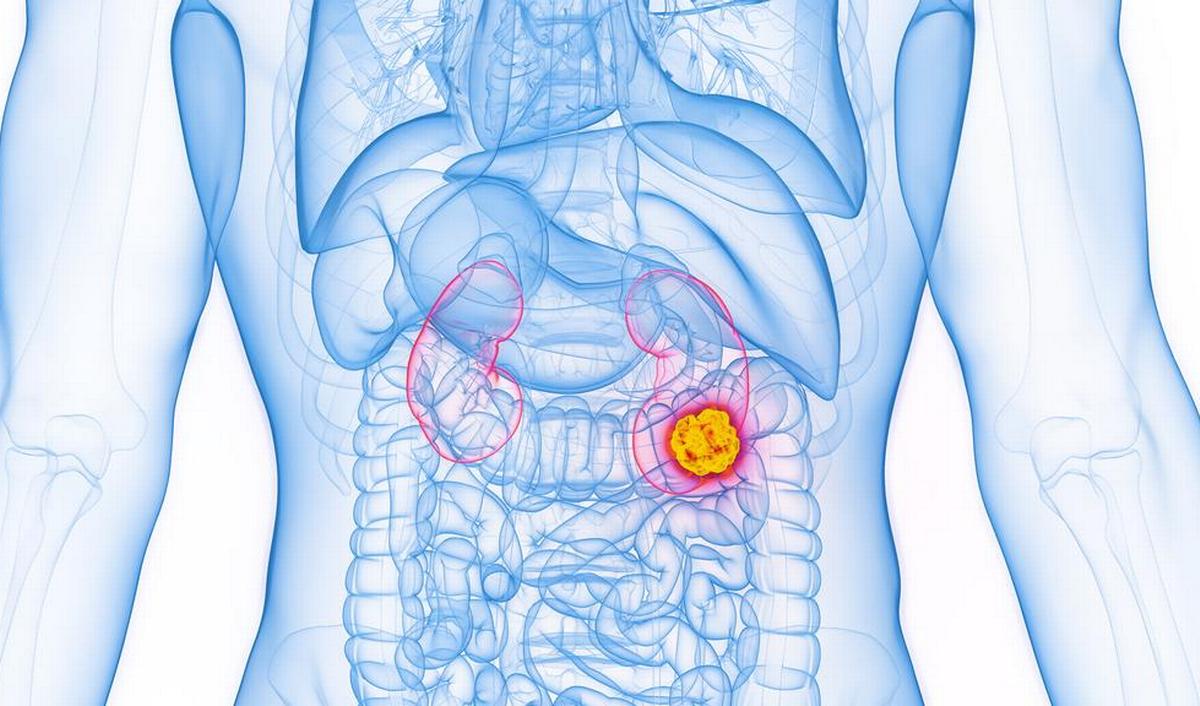 Wat zijn de symptomen van nierkanker? | gezondheid.be
