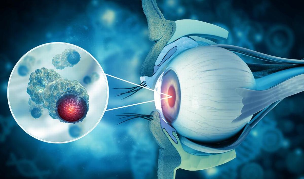 Oogkanker: symptomen, behandeling en prognose | gezondheid.be