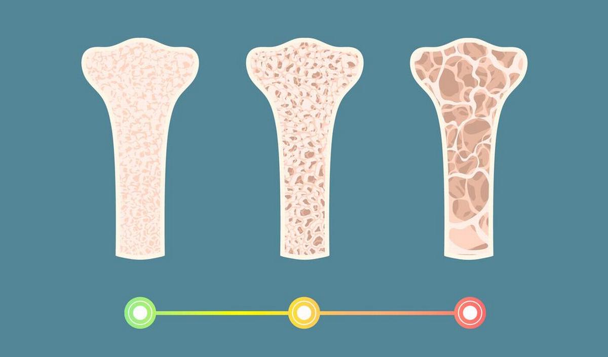 Osteopenie: verminderde botmassa | gezondheid.be