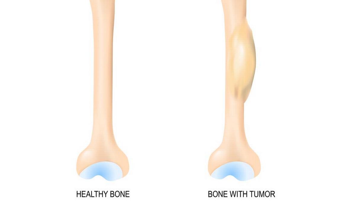 Botkanker: osteosarcoom en multiple myeloom (ziekte van Kahler ...