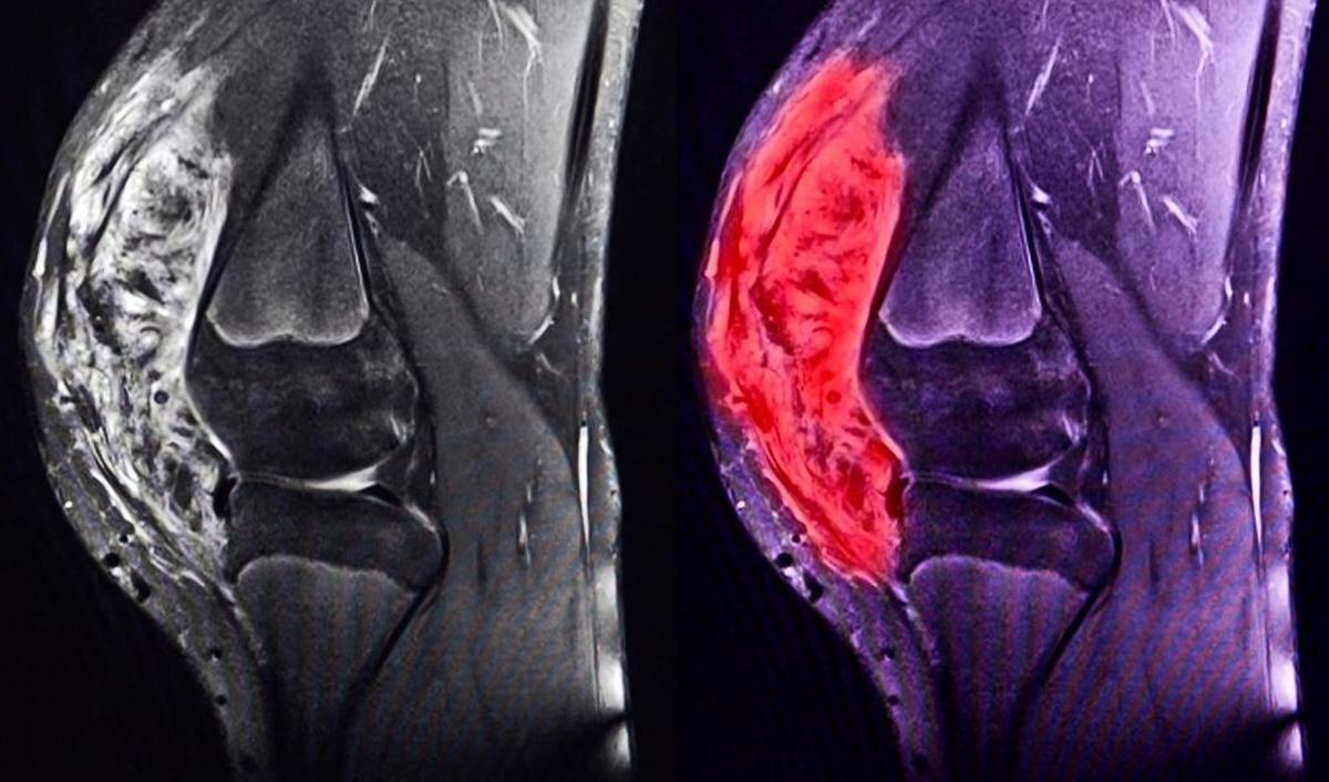 Kanker: welke symptomen wijzen op sarcoom? | gezondheid.be