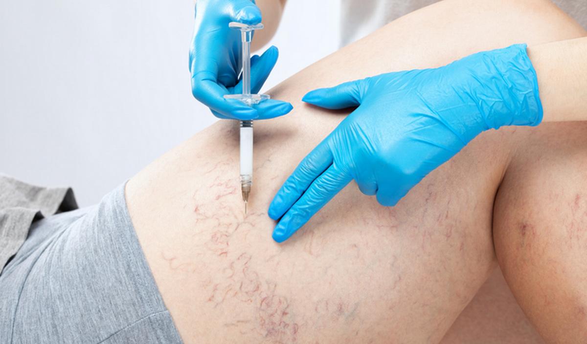 Behandeling veneuze insufficiëntie: wat helpt bij zware benen en ...