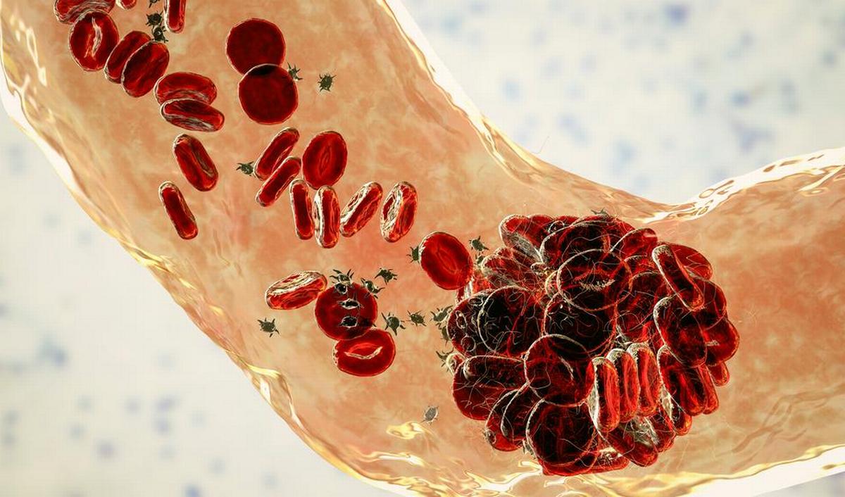 Wat zijn de symptomen van een trombose? | gezondheid.be