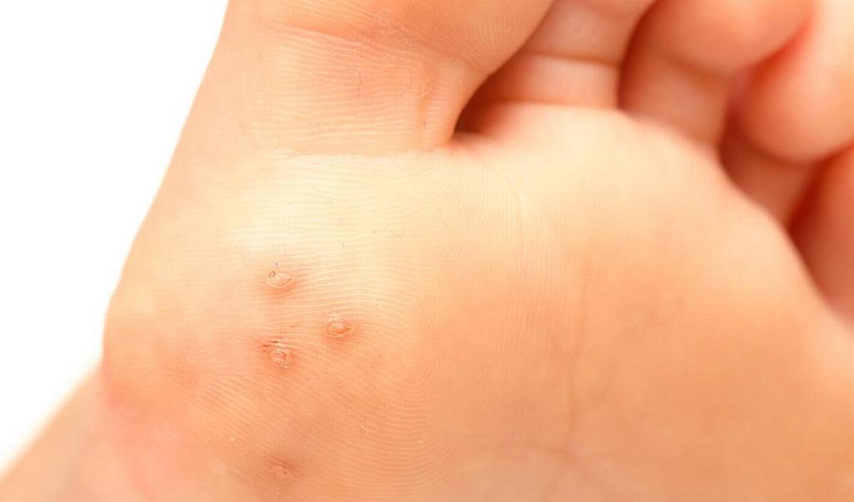 Welke soorten wratten zijn er? | gezondheid.be