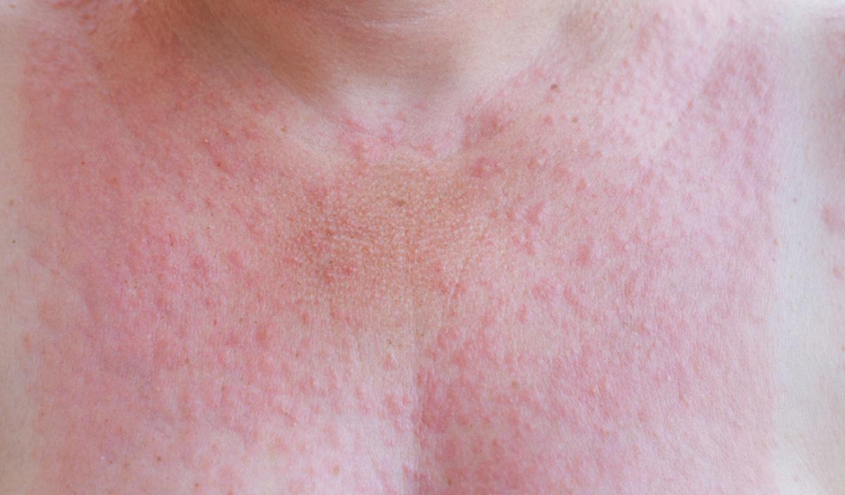 Hoelang duurt een zonneallergie? | gezondheid.be